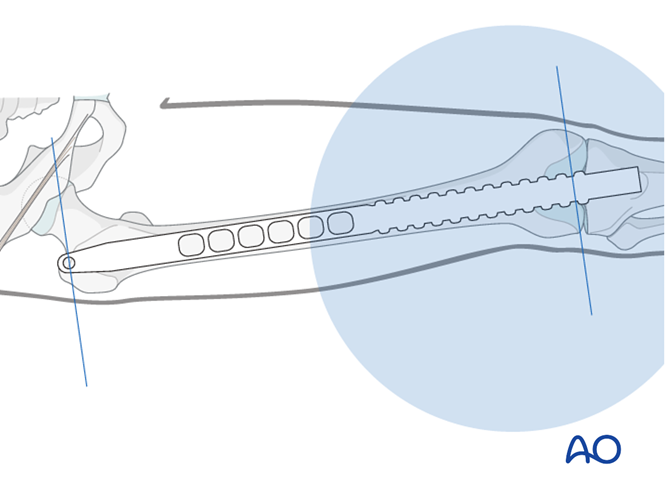 Retrograde nailing for Simple, transverse, distal 1/3 fractures