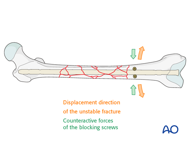 Retrograde nailing for Simple, oblique, middle 1/3 fractures