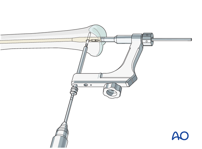 Retrograde nailing for Simple, oblique, middle 1/3 fractures