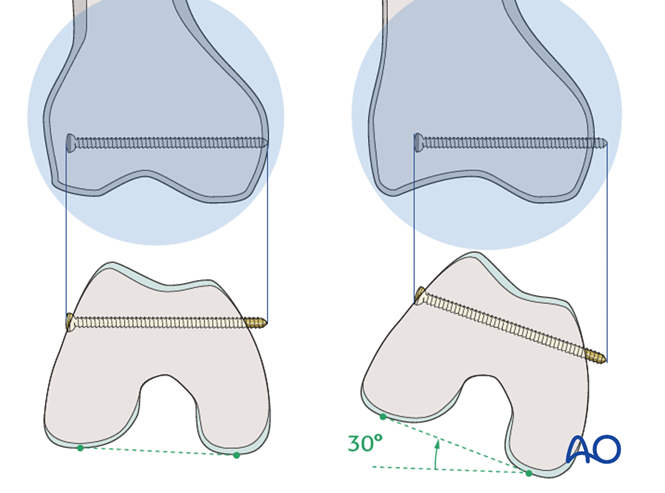 Retrograde nailing for Simple, oblique, middle 1/3 fractures