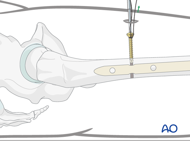 Retrograde nailing for Simple, transverse, distal 1/3 fractures