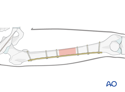 MIO - Bridge plating for Segmental, fragmentary, middle 1/3 fractures