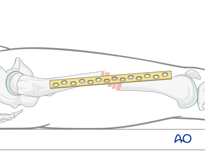 MIO - Bridge plating for Segmental, fragmentary, middle 1/3 fractures