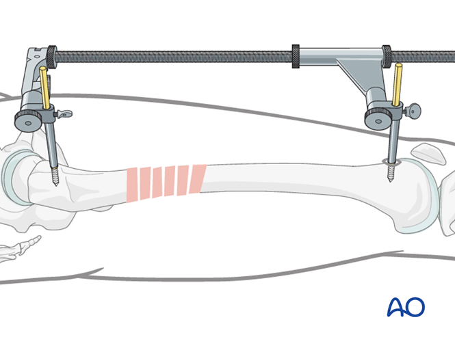 MIO - Bridge plating (Locking plate) for Wedge, fragmentary, proximal 1 ...