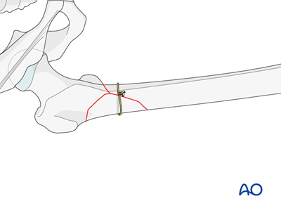 MIO - Bridge plating (Locking plate) for Wedge, fragmentary, proximal 1 ...
