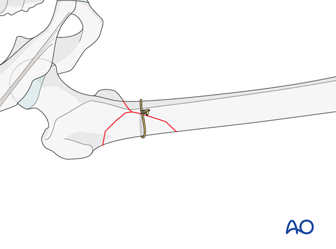 MIO - Bridge plating (Locking plate) for Wedge, fragmentary, proximal 1 ...