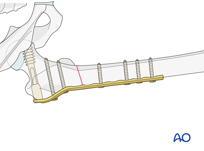 ORIF - Compression plating (DCS) for Simple, transverse, proximal 1/3 ...