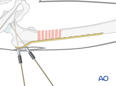 MIO - Bridge plating (Locking plate) for Wedge, fragmentary, proximal 1 ...