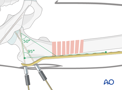 MIO - Bridge plating (Locking plate) for Wedge, fragmentary, proximal 1 ...