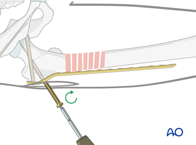 MIO - Bridge plating (Locking plate) for Wedge, fragmentary, proximal 1 ...