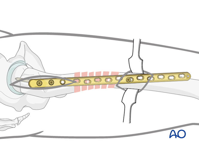 MIO - Bridge plating (Locking plate) for Segmental, fragmentary ...