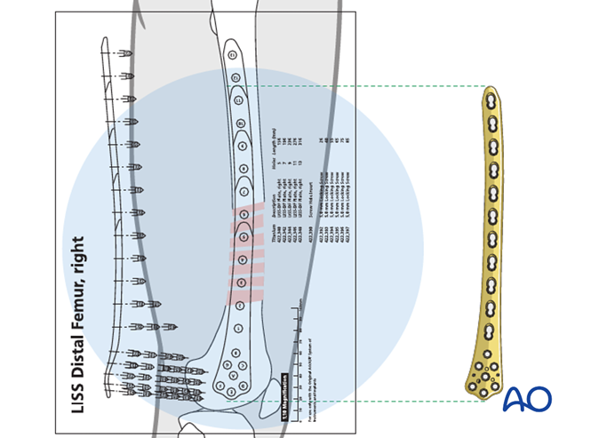 MIO - Bridge plating (LISS or LCP) for Segmental, intact, distal 1/3 ...
