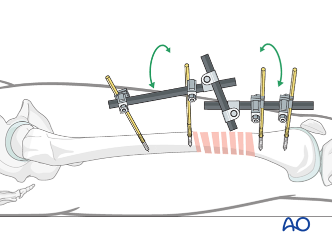 MIO - Bridge plating (LISS or LCP) for Segmental, fragmentary, distal 1 ...