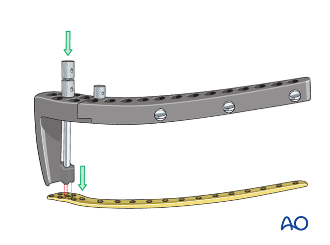 MIO - Bridge plating (LISS or LCP) for Segmental, fragmentary, distal 1 ...