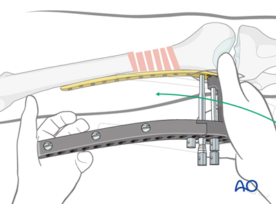MIO - Bridge plating (LISS or LCP) for Segmental, fragmentary, distal 1 ...