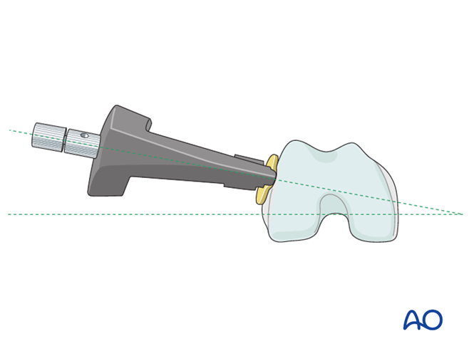 MIO - Bridge plating (LISS or LCP) for Segmental, fragmentary, distal 1 ...