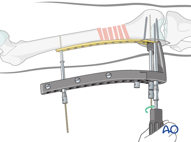 MIO - Bridge plating (LISS or LCP) for Segmental, fragmentary, distal 1 ...