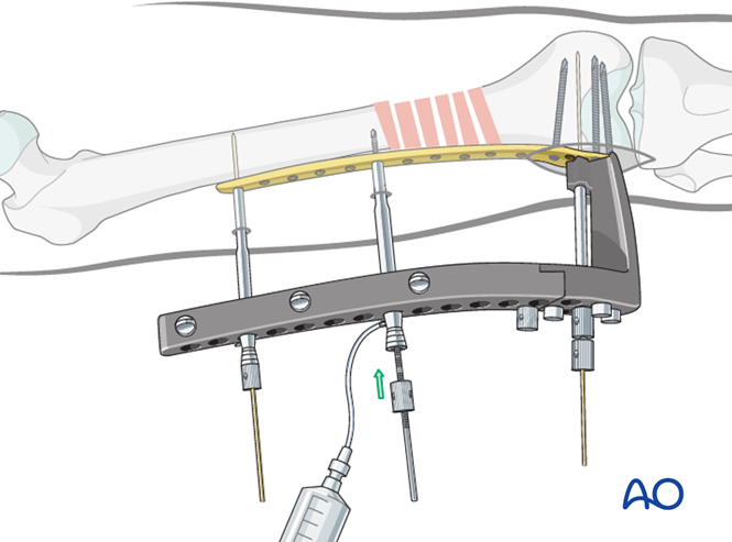 MIO - Bridge plating (LISS or LCP) for Segmental, fragmentary, distal 1 ...