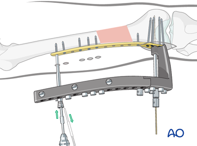 MIO - Bridge plating (LISS or LCP) for Segmental, fragmentary, distal 1 ...