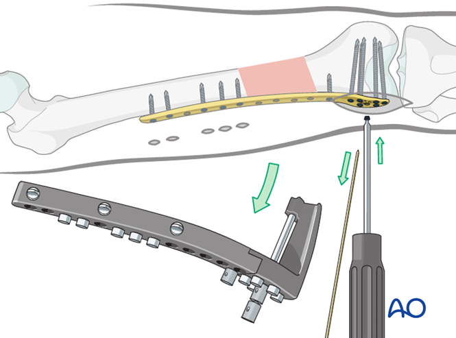 MIO - Bridge plating (LISS or LCP) for Segmental, fragmentary, distal 1 ...