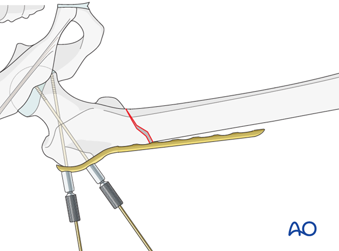 ORIF - Compression plating (Locking plate) for Simple, oblique ...