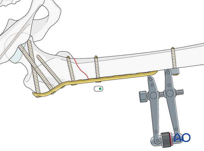 ORIF - Compression plating (Locking plate) for Simple, oblique ...