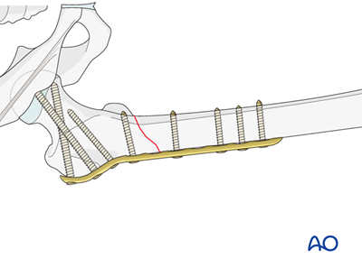 ORIF - Compression plating (Locking plate) for Simple, oblique ...