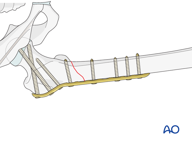 ORIF - Compression plating (Locking plate) for Simple, oblique ...