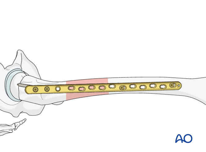 ORIF - Bridge plating (Locking plate) for Wedge, fragmentary, proximal ...