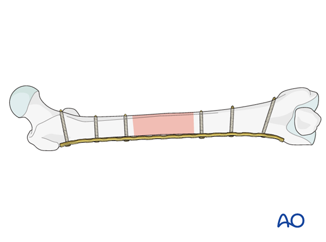 ORIF - Bridge plating for Segmental, fragmentary, middle 1/3 fractures