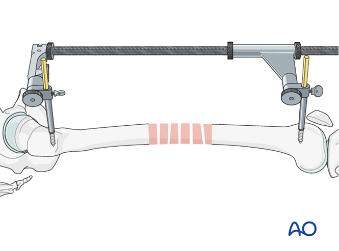 ORIF - Bridge plating for Segmental, intact, middle 1/3 fractures