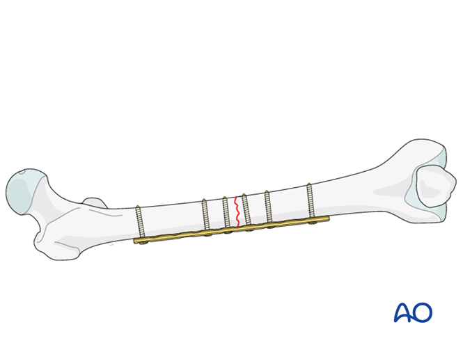 ORIF - Compression plating for Simple, transverse, middle 1/3 fractures