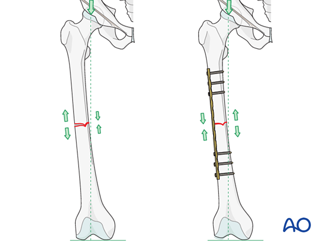 ORIF - Compression plating for Simple, transverse, middle 1/3 fractures