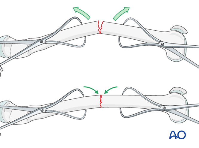 ORIF - Compression plating for Simple, transverse, middle 1/3 fractures