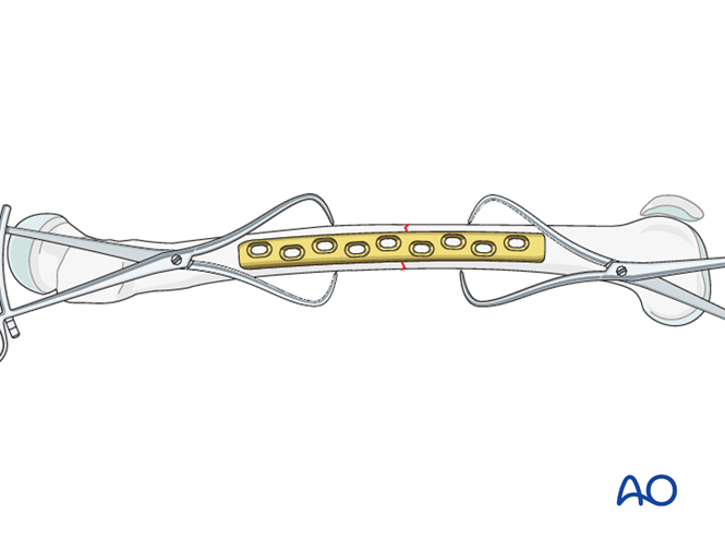 ORIF - Compression plating for Simple, transverse, middle 1/3 fractures