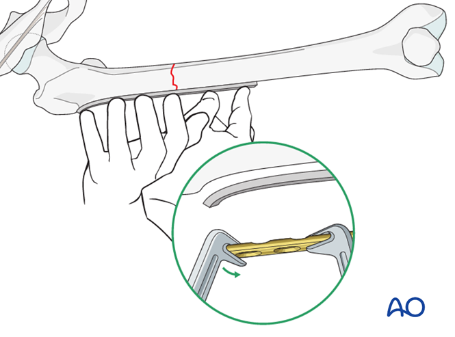 ORIF - Compression plating for Simple, transverse, middle 1/3 fractures