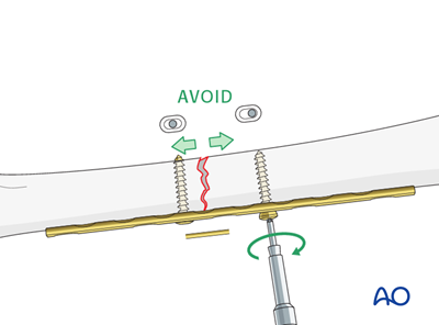 ORIF - Compression plating for Simple, transverse, middle 1/3 fractures