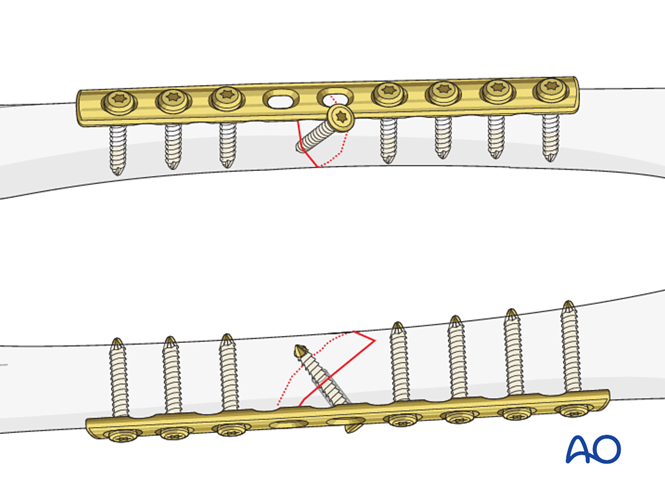 ORIF - Lag screw with protection plate for Simple, oblique, middle 1/3 ...