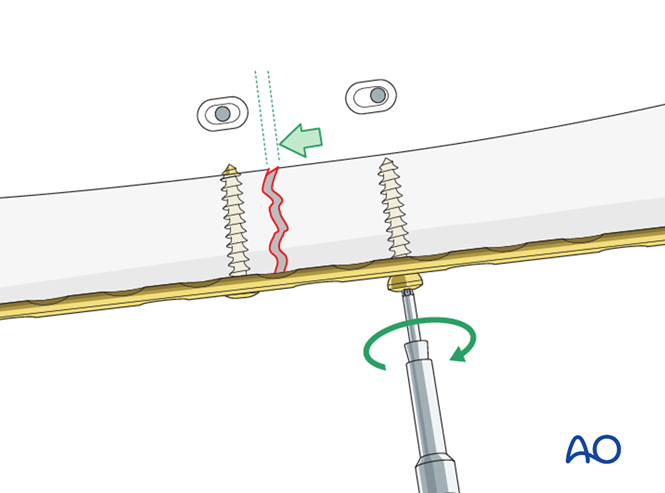 ORIF - Compression plating for Simple, transverse, middle 1/3 fractures