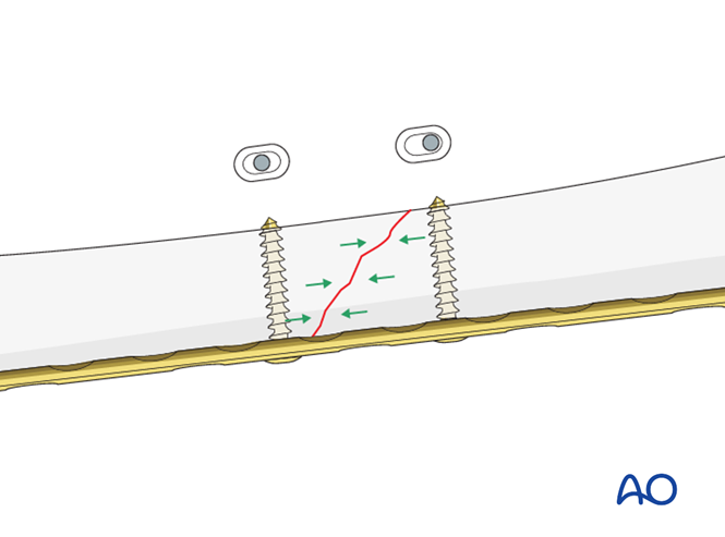 ORIF - Compression plating (Locking plate) for Simple, oblique ...