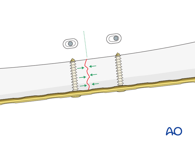 ORIF - Compression plating for Simple, transverse, middle 1/3 fractures