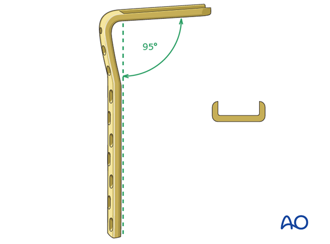 ORIF - Bridge plating (blade plate) for Simple, transverse, proximal 1/ ...