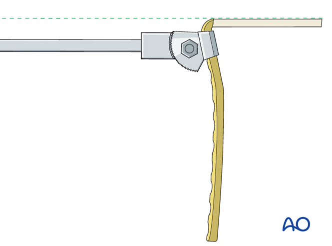 ORIF - Bridge plating (blade plate) for Simple, transverse, proximal 1/ ...