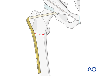 ORIF - Bridge plating (blade plate) for Simple, transverse, proximal 1/ ...