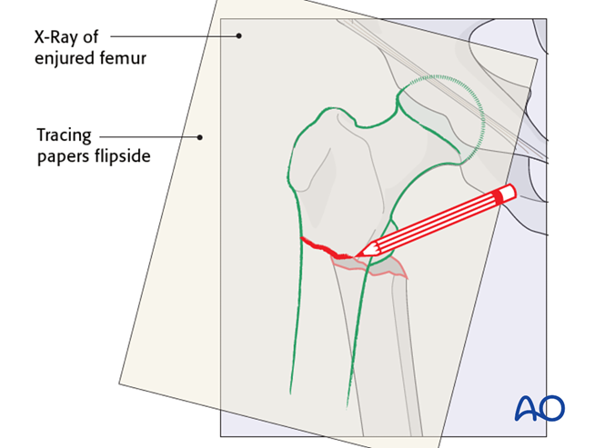 ORIF - Bridge plating (blade plate) for Simple, transverse, proximal 1/ ...