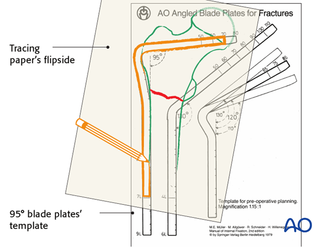 ORIF - Bridge plating (blade plate) for Simple, transverse, proximal 1/ ...