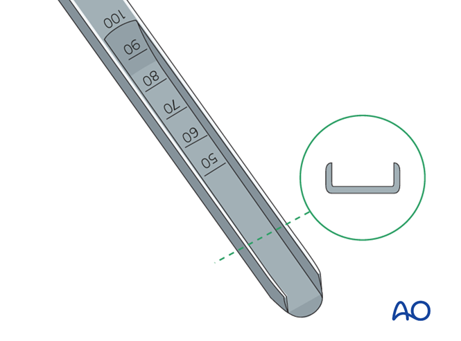 ORIF - Bridge plating (blade plate) for Simple, transverse, proximal 1/ ...