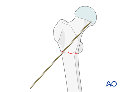 ORIF - Bridge plating (blade plate) for Simple, transverse, proximal 1/ ...