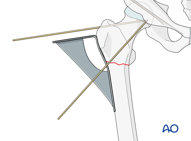 ORIF - Bridge plating (blade plate) for Simple, transverse, proximal 1/ ...