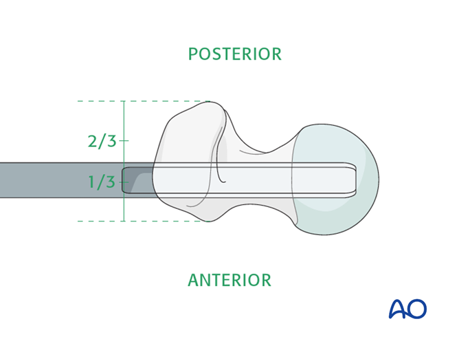 ORIF - Bridge plating (blade plate) for Simple, transverse, proximal 1/ ...